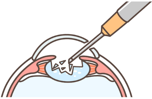 Cataracts - Boulder Eye Surgeons