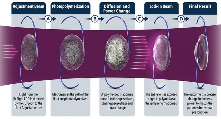 RxSight Adjustable Lens at Boulder Eye Surgeons